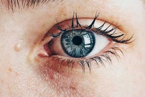 Is My Skin Rash A Sign Of Hepatitis C? - Urticaria and HCV